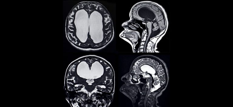 Hydrocephalus Symptoms, Treatment, & Causes - BSSNY