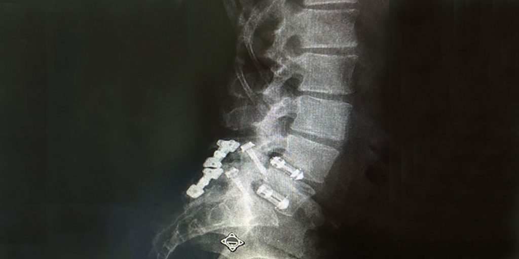 Fractured Spinal Hardware Symptoms & Treatments - BSSNY