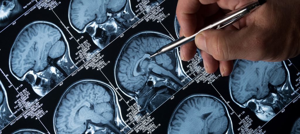 Seizure Focus Surgery - Brain & Spine Surgeons of New York